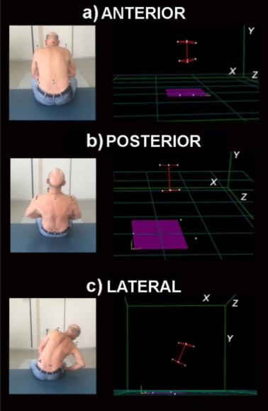 Trunk recovery in stroke patients using 3D kinematic analysis: a useful ... Trunk recovery in stroke patients using 3D kinematic analysis: a useful ...